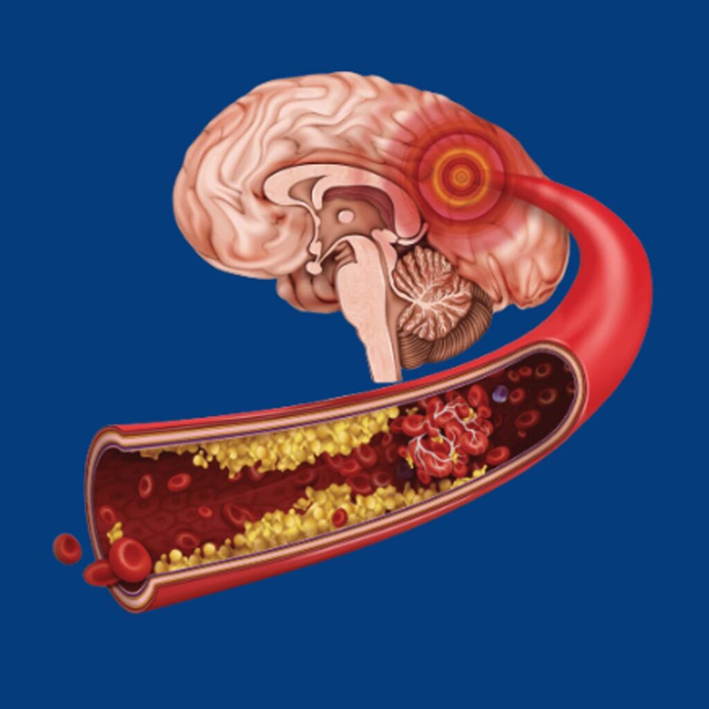 Stroke – MPC